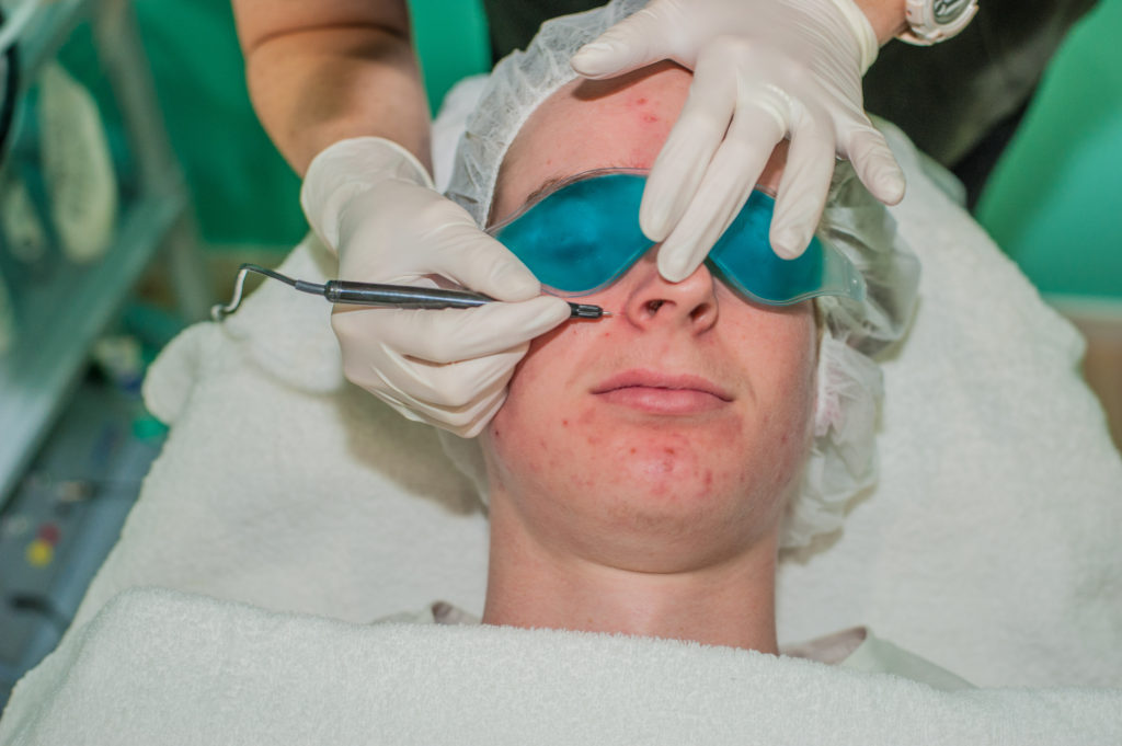 » Sebaceous Gland Ablation